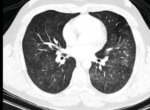 EVALI: La enfermedad pulmonar asociada al uso de cigarrillos ...