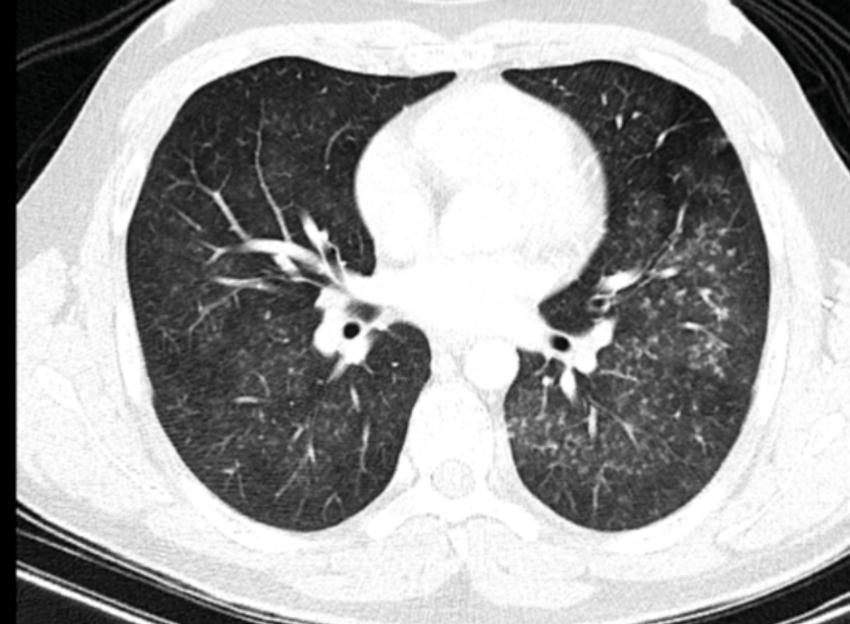 EVALI: La enfermedad pulmonar asociada al uso de cigarrillos ...