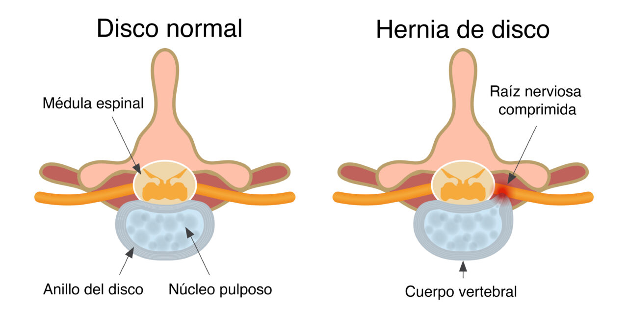 Hernia discal lumbar: una guía clara para entenderla y afrontarla ...